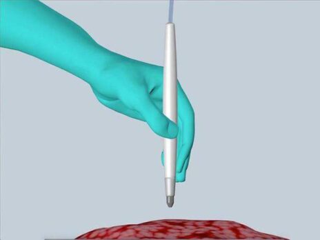 University of Texas’ new MasSpec Pen identifies cancer within seconds ...