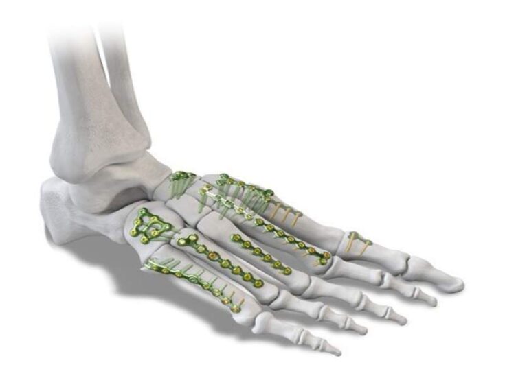 Paragon 28 introduces new small bone fixation system for foot and ankle ...