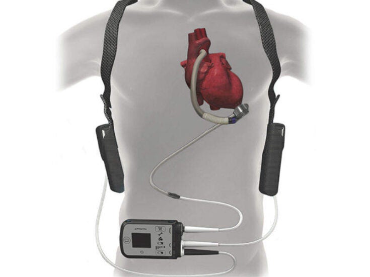Cardiac pump improves long-term outcomes for heart failure patients ...
