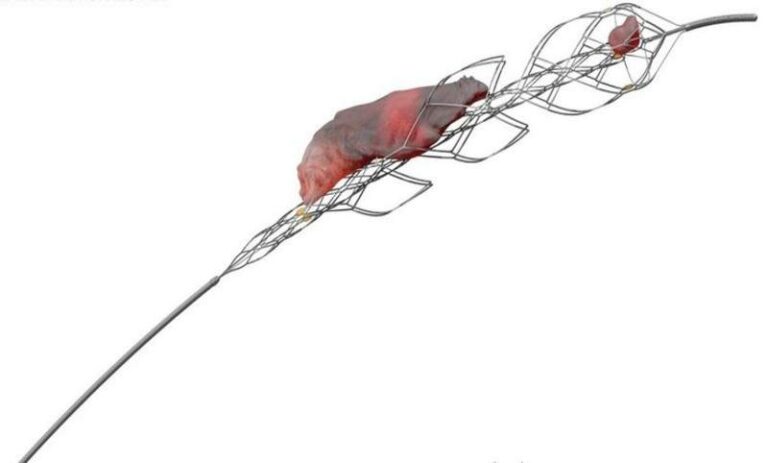J&J’s Cerenovus gets FDA approval for stent retriever device - Medical Device Network