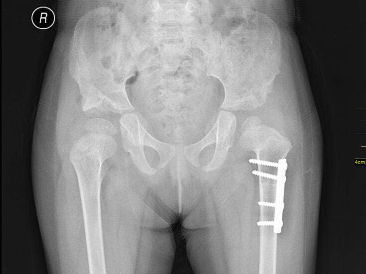 Cross-linked polyethylene hip implants lower rate of repeat surgery ...