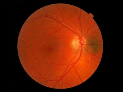 New 2D material based artificial retina could change millions of lives