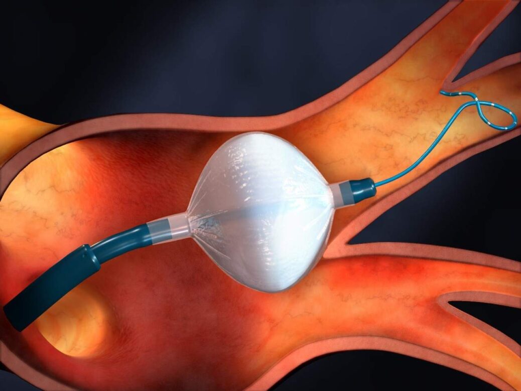Medtronic’s dominance in cryoablation may be coming to an end - Medical ...