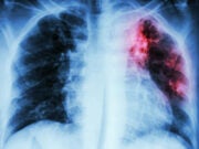 Tuberculosis blood test detects disease with 73% accuracy