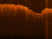 Smart wound sensors detect tissue healing through soundwaves