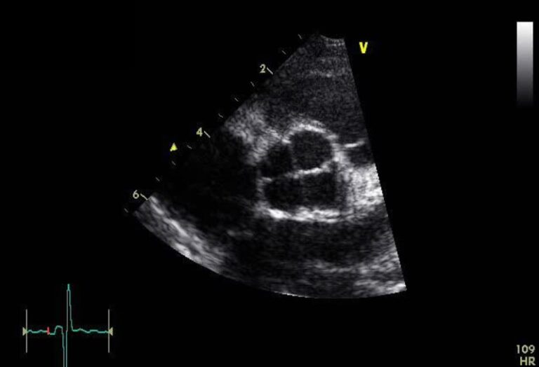 Edwards Lifesciences secures approval for SAPIEN 3 TAVI valve in Europe