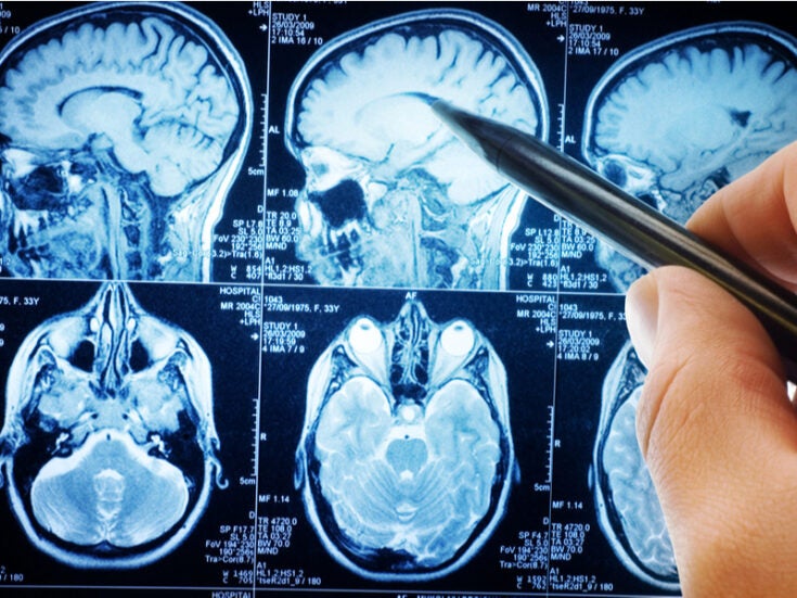 MRI scans prove useful for understanding depression