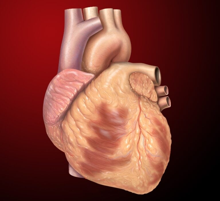Abbott receives FDA nod for heart pump implant procedure