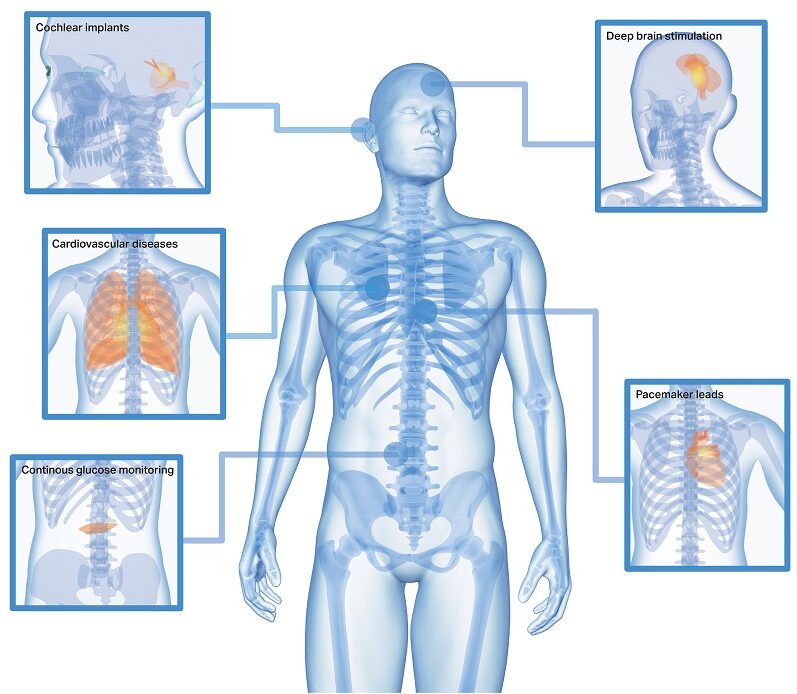EXERA ®: Customised wire-configurations for medical device solutions ...