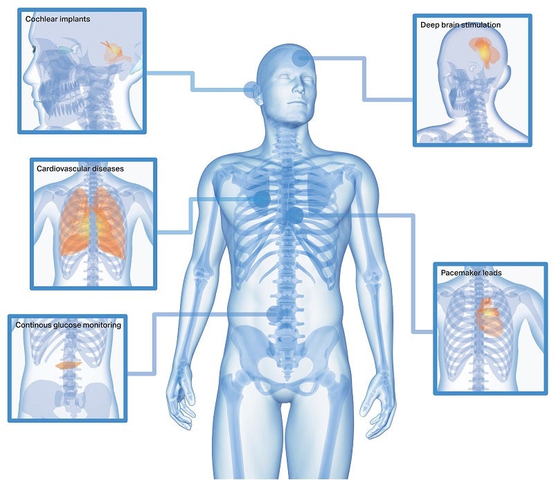 EXERA ®: Customised wire-configurations for medical device solutions ...