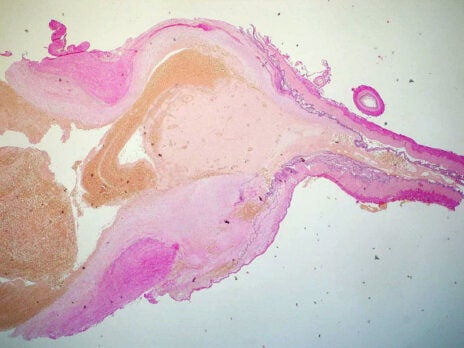 Cerus Endovascular receives CE Mark for aneurysms treatment device