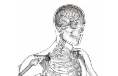 Medical devices in-depth product overview: deep brain stimulation systems