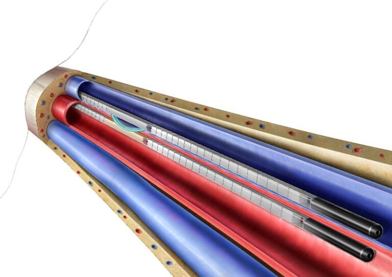 BD treats first subjects in study of WavelinQ system for fistula creation