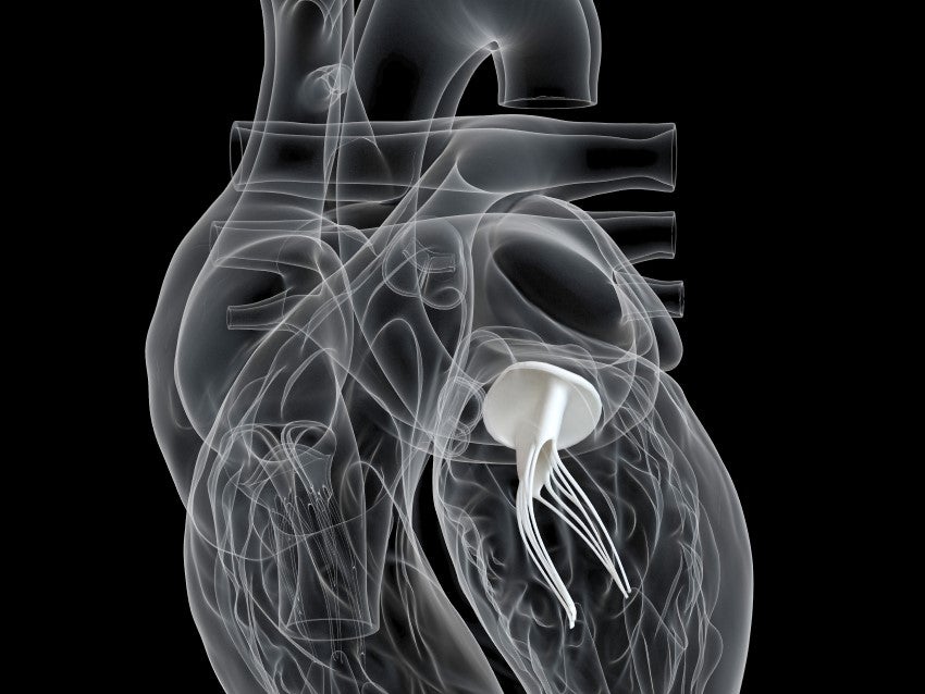 CE mark awarded to Phoenix Cardiac Devices’ BACE system - Medical ...