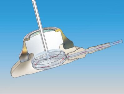 C-Port CT® - a Successful Medical Product - Medical Device Network