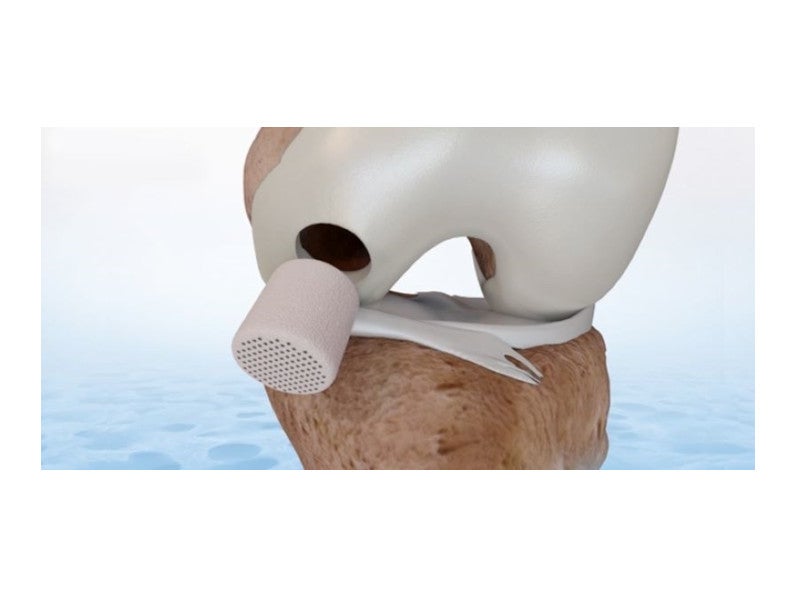 CartiHeal’s Agili-C Implant, USA