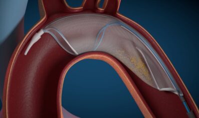 How a new cardiovascular filtration system is reducing stroke risk ...