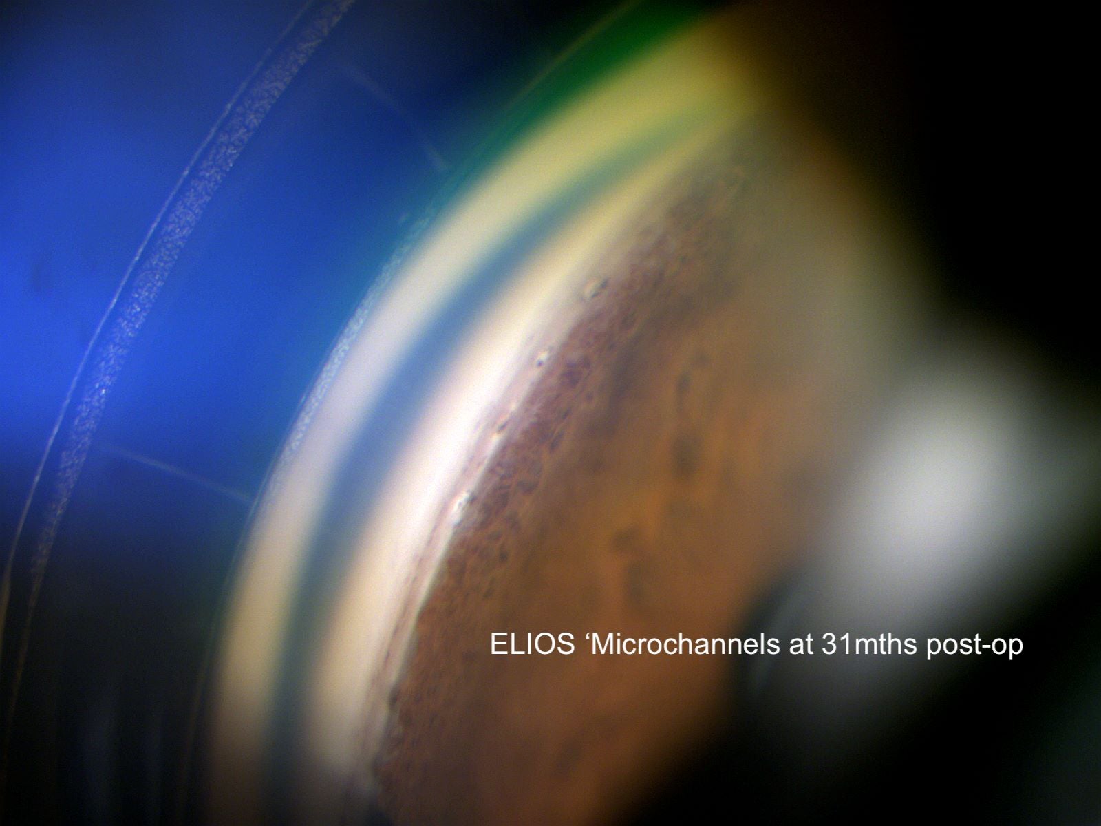 Medical Device Network Excellence Awards 2023: Elios Vision