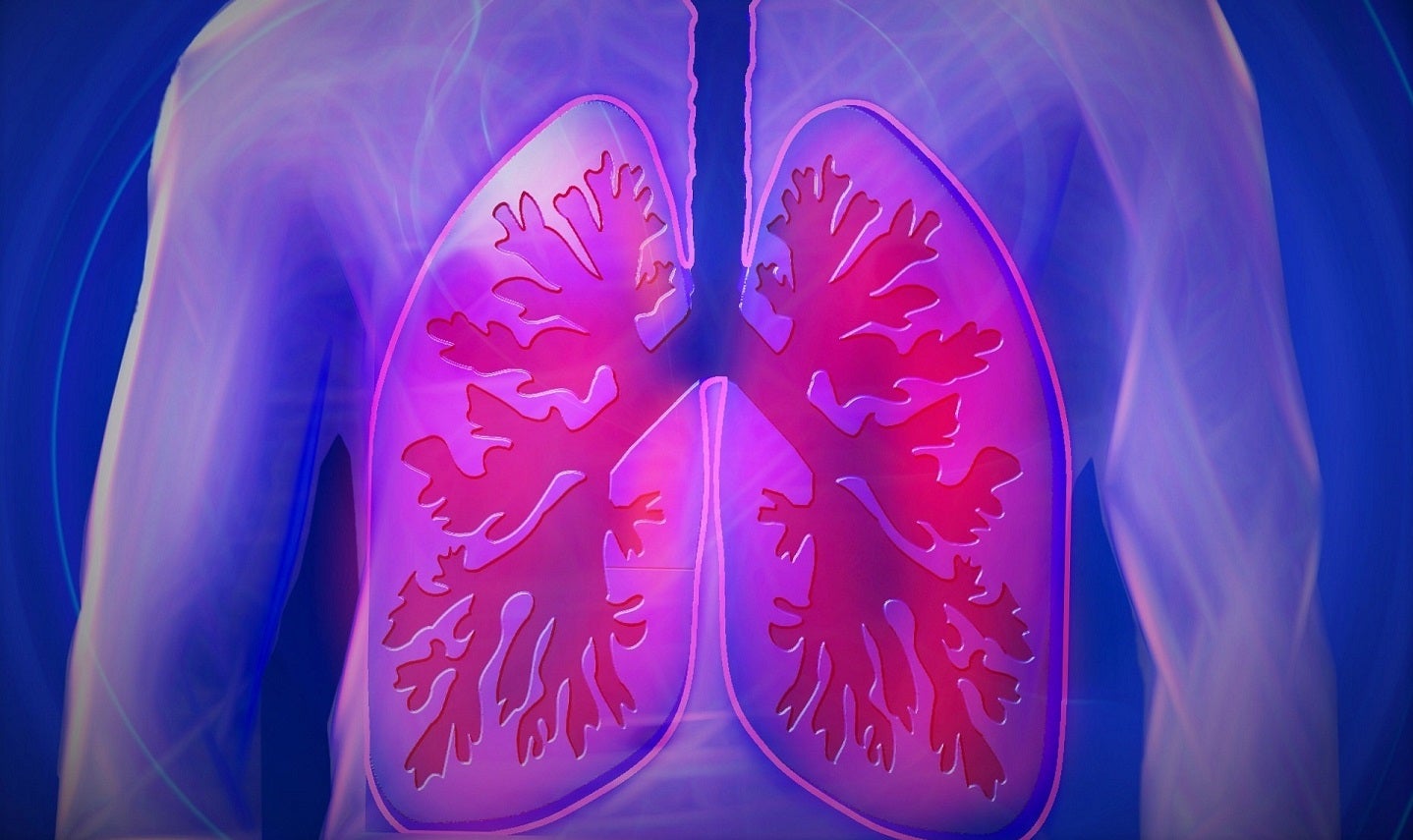 Pulmonx treats first subject with AeriSeal system in COPD trial