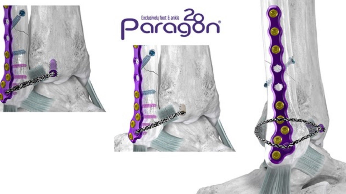 Paragon 28 launches new solution for ankle ligament repair
