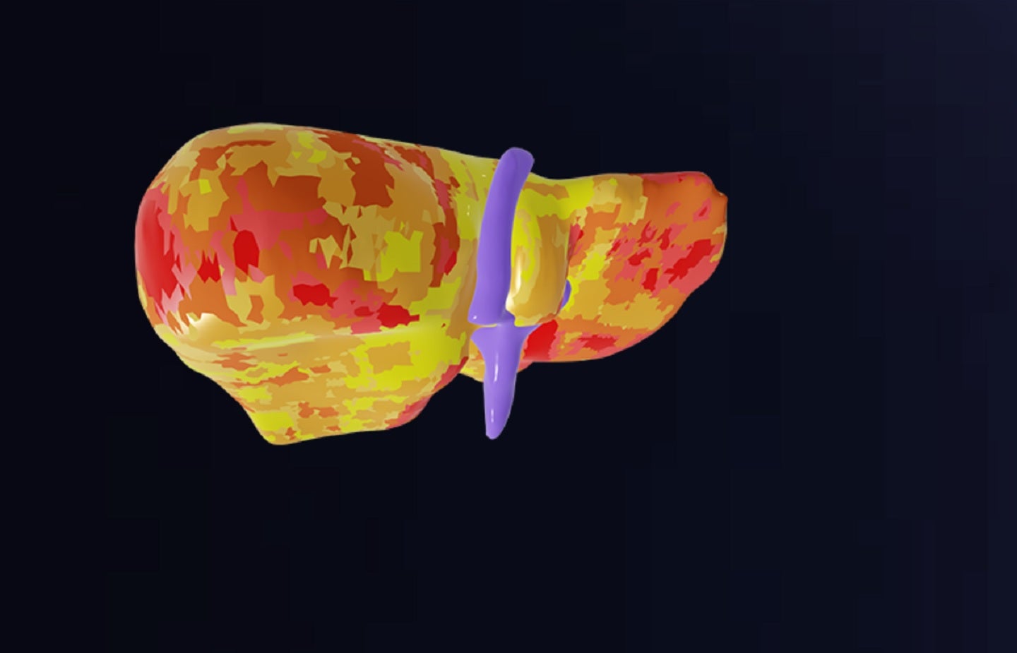 Quibim launches QP-Liver tool for diffuse liver disease diagnosis