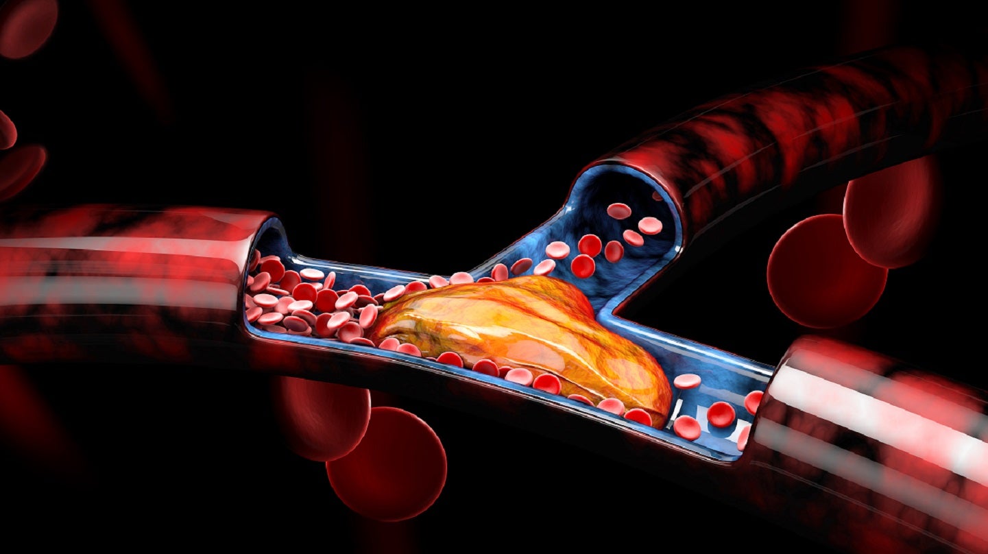 Medtronic launches Avalus Ultra surgical aortic tissue valve