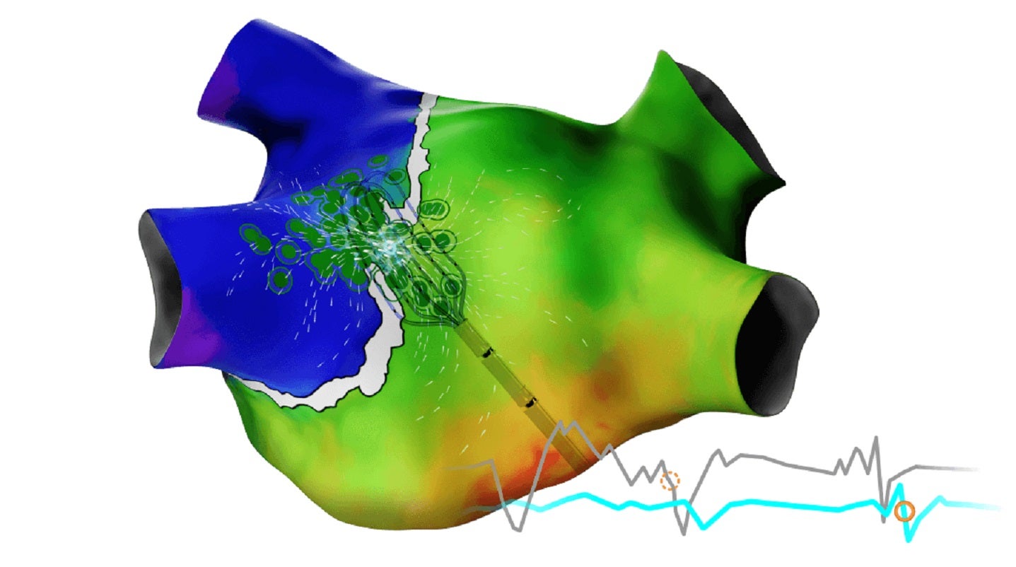 Biosense introduces CARTO 3 System Version 8