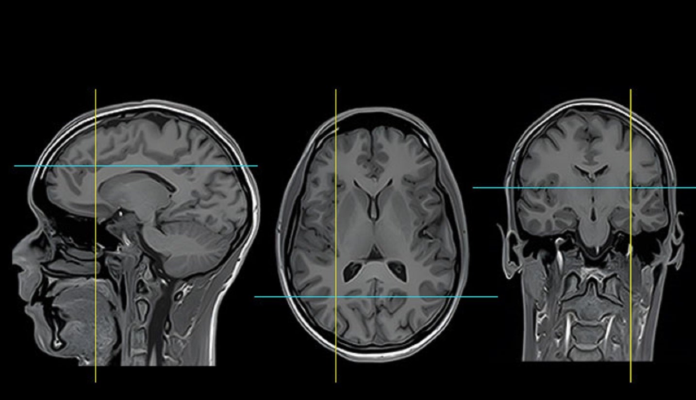 SyntheticMR’s SyMRI version 15 secures CE mark