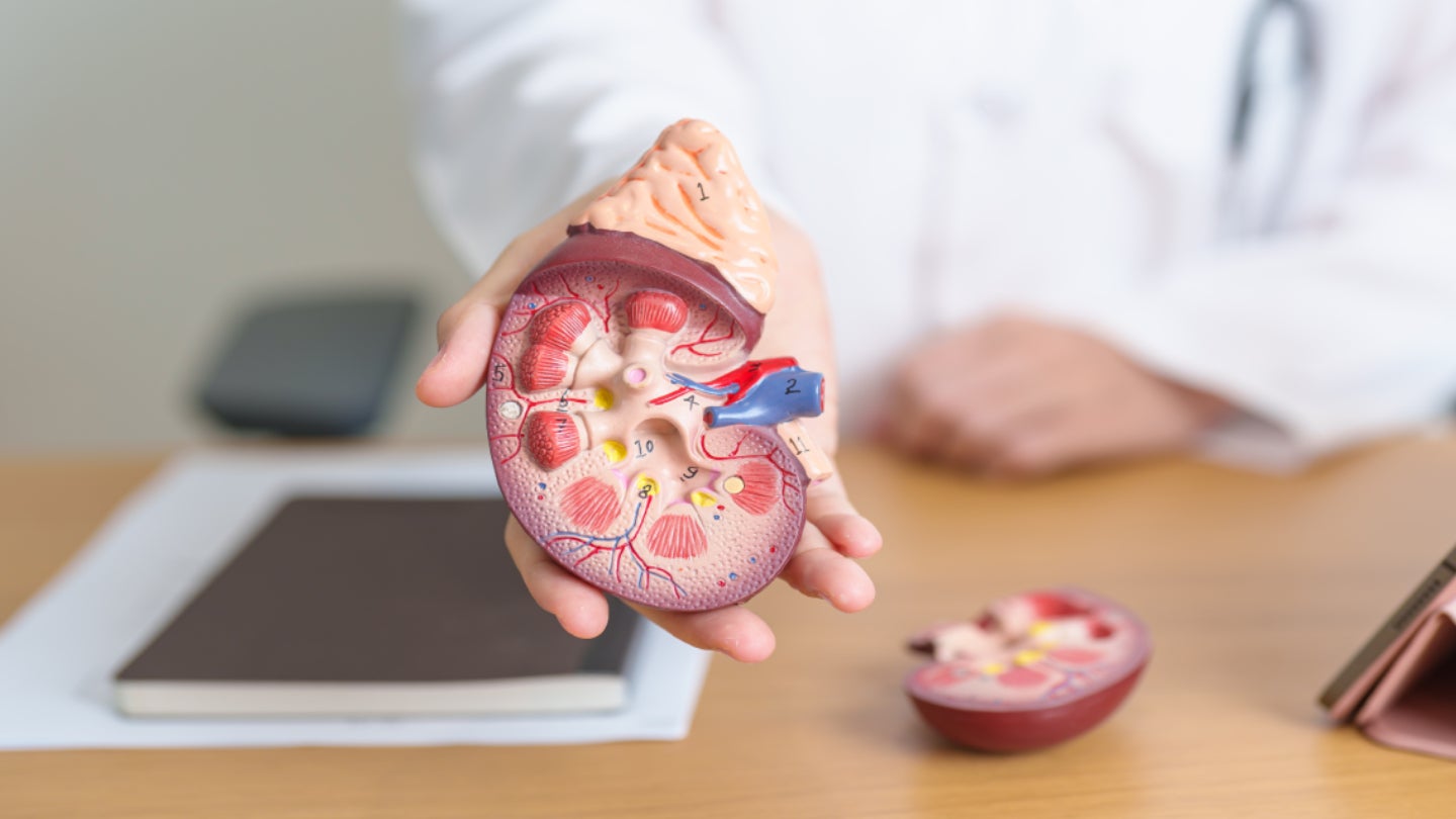 Calyxo study finds CVAC system keeps kidney stone patients out of ...