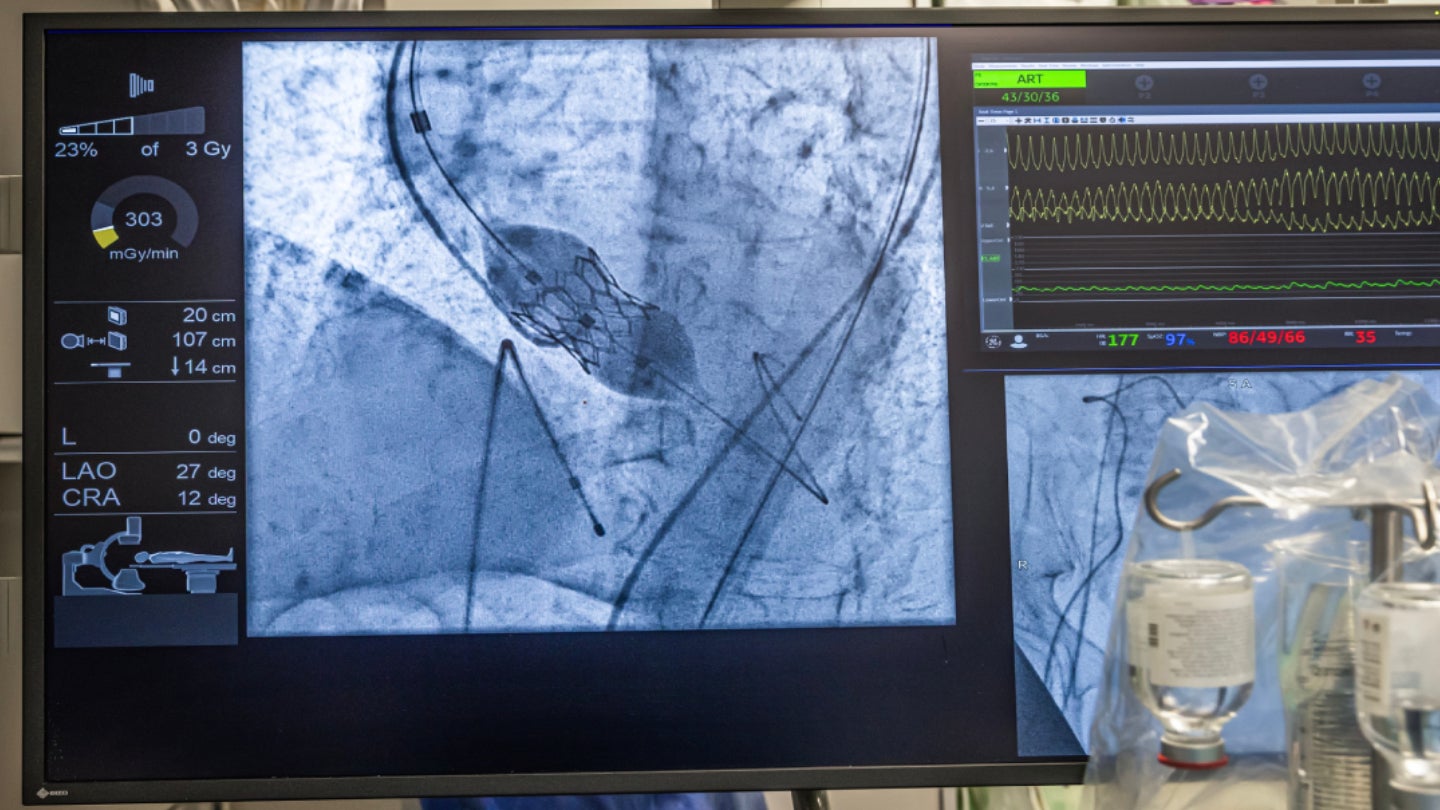 Vivasure sees success in absorbable large-bore vessel device trial ...