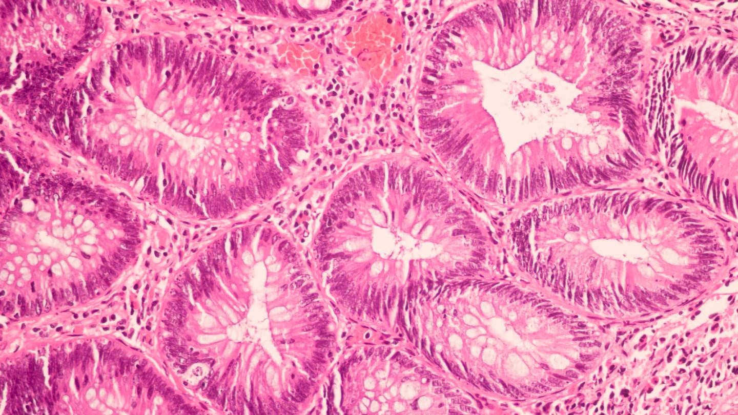 Telix Pharma doses first patient in Phase III PET carcinoma trial ...