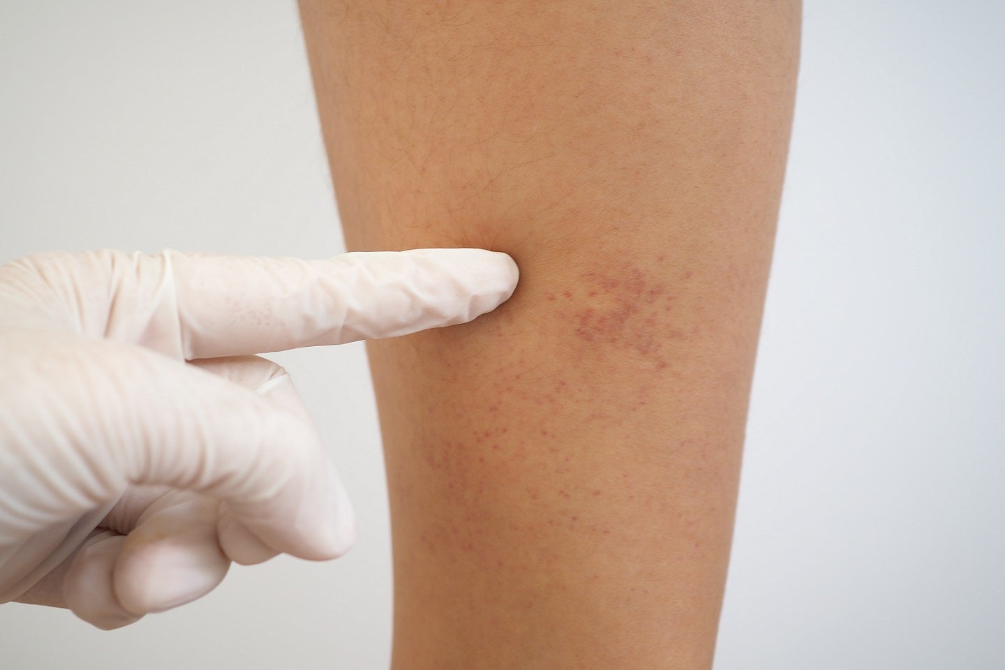 Stryker agrees to acquire Inari Medical for $4.9bn