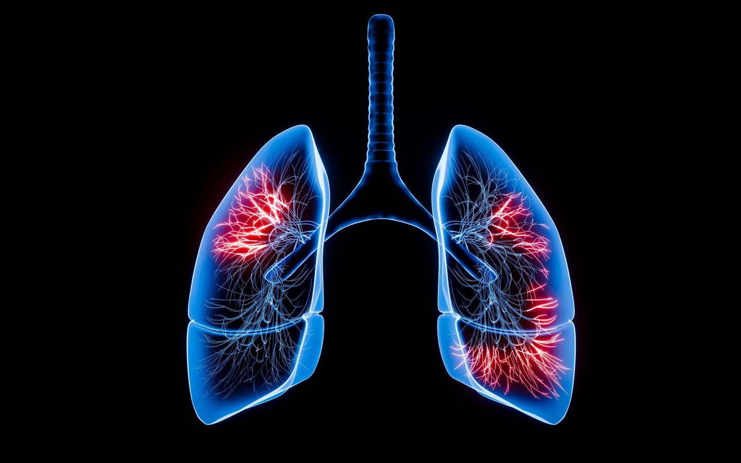 Apreo Health raises $130m to fund emphysema implant pivotal trial ...