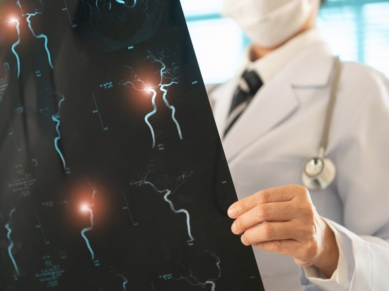 Penumbra's SwiftPAC Neuro Embolisation Coil, USA