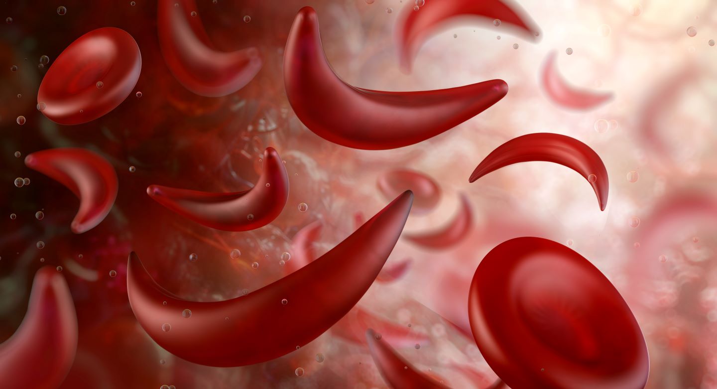 Sanius continues AI investment to advance platform for sickle cell ...